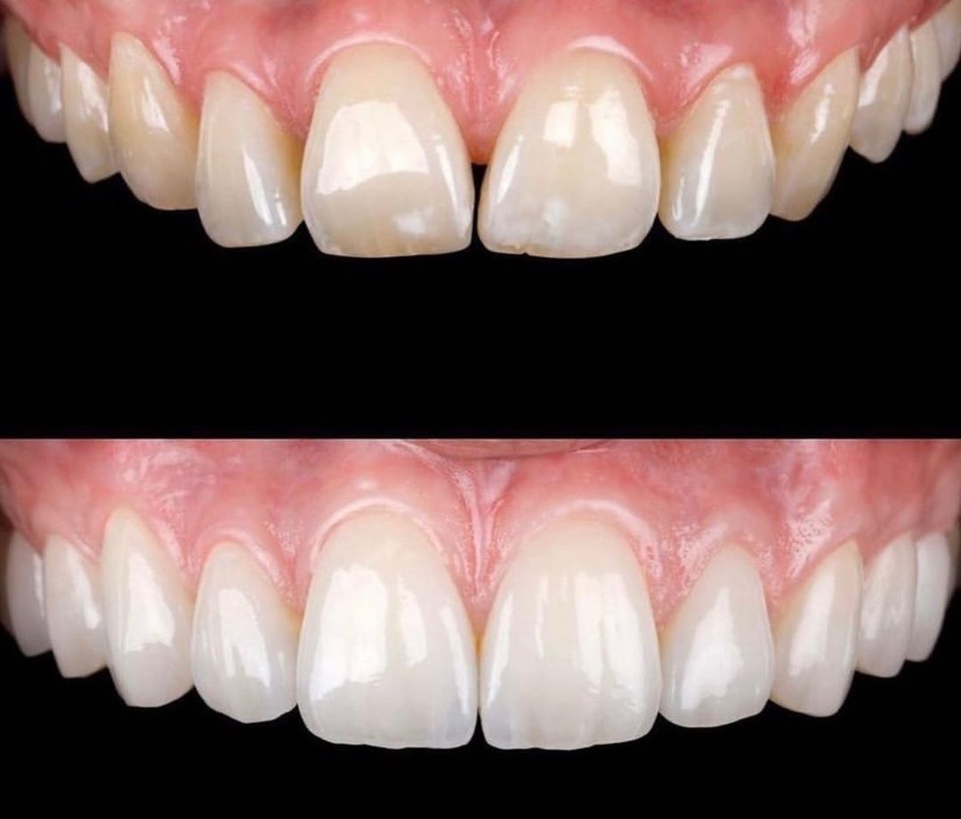 Smile Design - Dr. Tansu Uzel